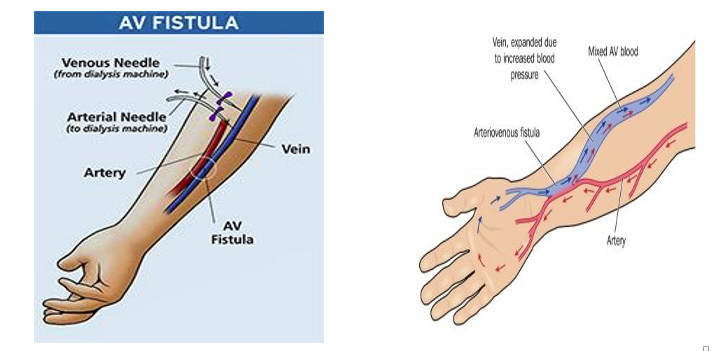 Aplagon - Keeping blood vessels open - Invesdor